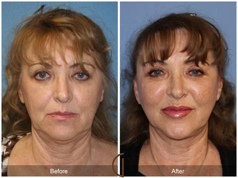 Before And After Fat Grafting Procedures In Newport Beach Ca Orange