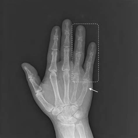 An X Ray Showing Left Distal Radius Fracture Of The Patient Arrow