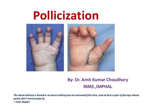 Pollicization
