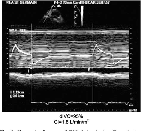 Figure 1 From Functional Hemodynamic Monitoring Semantic Scholar
