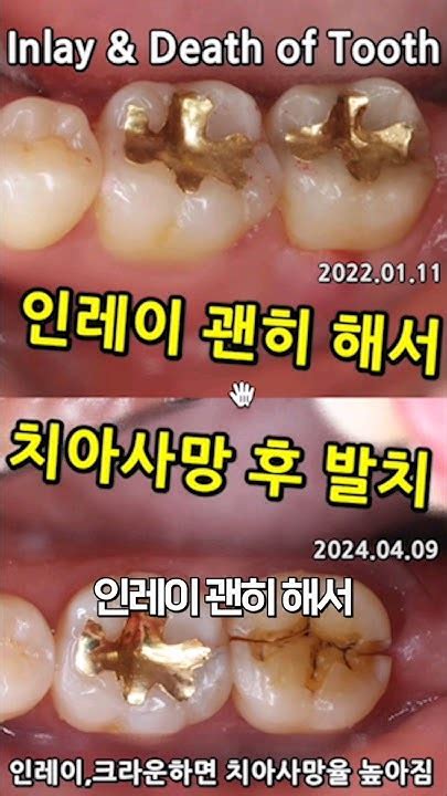 인레이했다가 치아사망 안하는게 정답 레진을 하세요 인레이치아사망 0820240504 Youtube