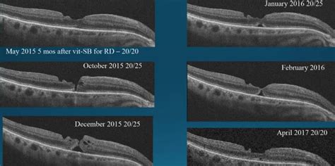 Pros And Cons Of Surgery For Lamellar Macular Holes American Academy