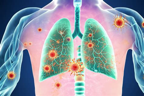 Pulmones Pertussis Tos Ferina Bordetella Pertussis Pulmones Con