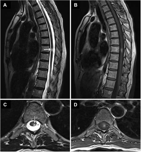 Early Multiple Sclerosis Mri