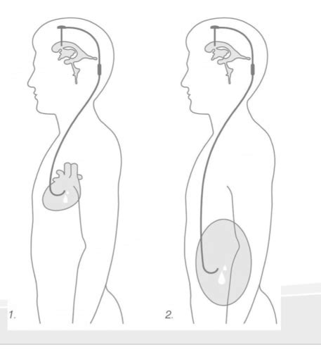 Intracranial Flashcards Quizlet