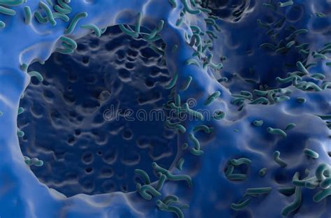 Bone Cancer Osteosarcoma Closeup View 3d Illustration Stock Illustration Illustration Of