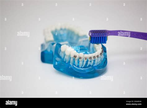 Typodont With The Installation Of The Braces With A Toothbrush Stock