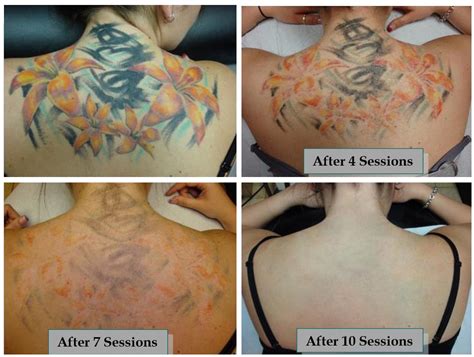 How Many Sessions To Remove Color Tattoo Rolf Mowery
