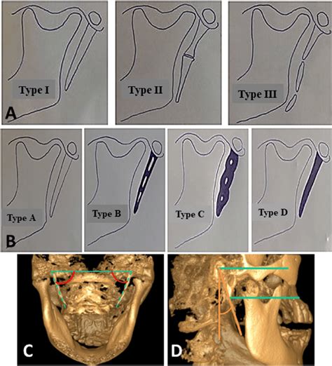 A Classification Of Morphology Of Elongated Styloid Process Esp