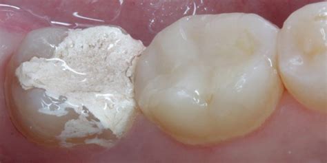 რითი მოვკლათ ნერვი კბილში სასარგებლო რჩევები