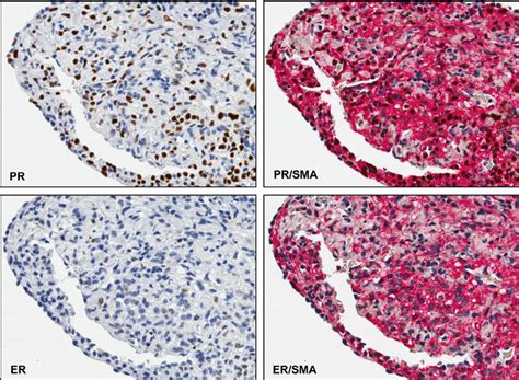 Immunohistochemical Study Of Pr And Er Expression In Representative