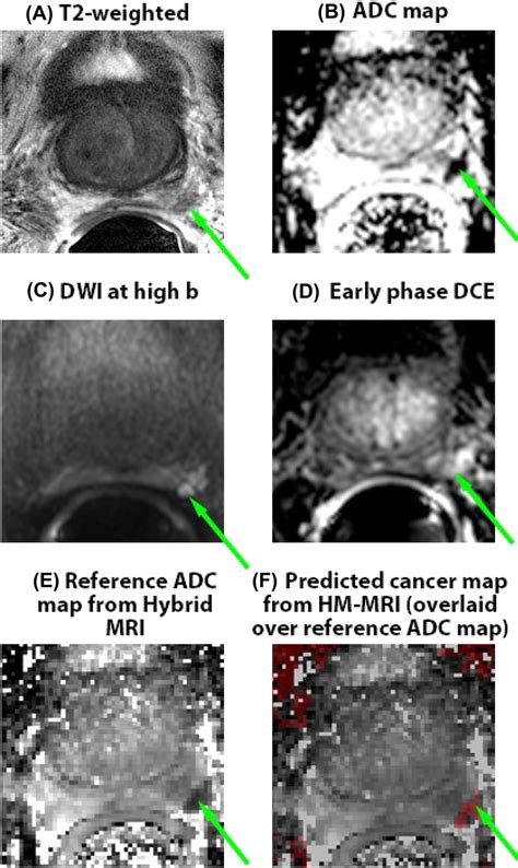 67 Year Old Patient With Rising Psa592 Ngml True Positive Download Scientific Diagram