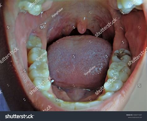 Wisdom Teeth In Mouth