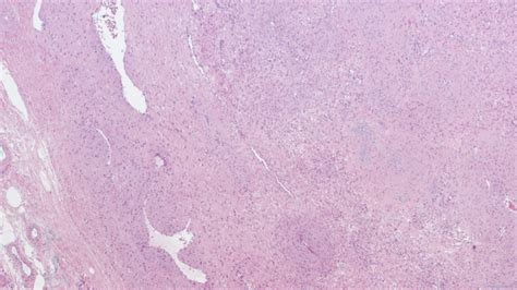 Myopericytoma Atlas Of Pathology