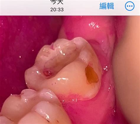 想問這是蛀牙嗎😭 牙齒矯正板 Dcard