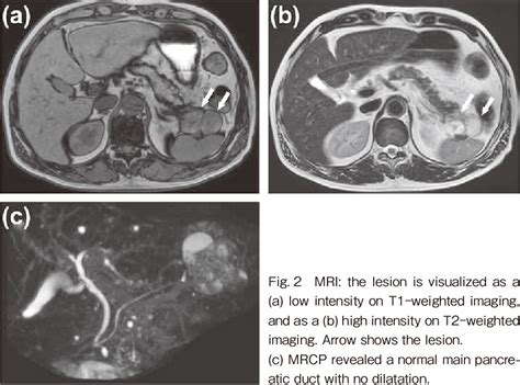 Figure 2 From A Case Of Lymphoepithelial Cyst Of The Pancreas