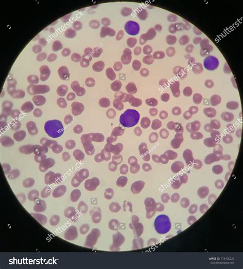 Promyelocyte