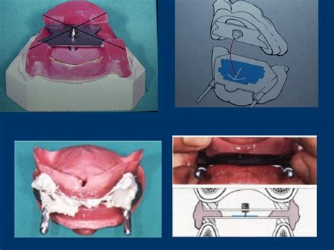 Jaw Relation