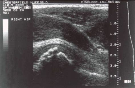 Transient Synovitis Of The Hip Prof Nicola Portinaro Orthopedic
