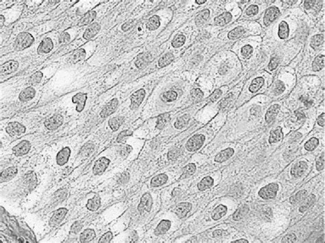 Bladder Tissue In Urine