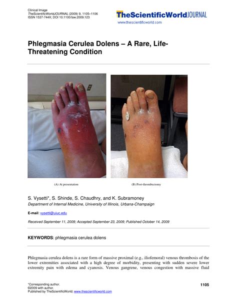 Phlegmasia Cerulea Dolens