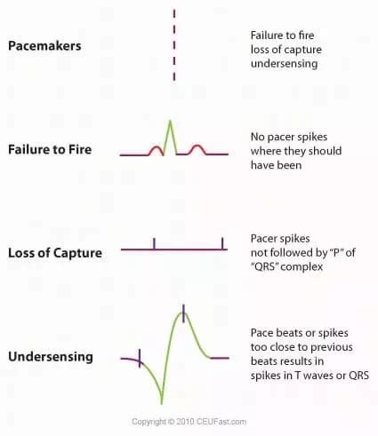 Ekg Nursing Artofit