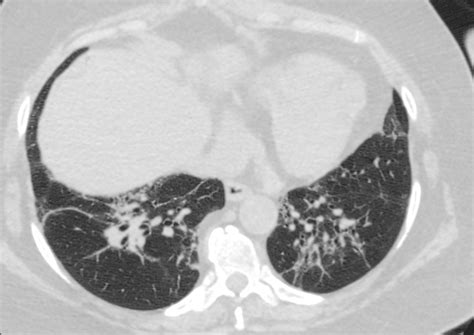 164lu Cryptogenic Organizing Pneumonia Cop Op Lungs