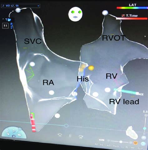 Electroanatomic Mapping Showing The Right Atrium And Right Ventricle Download Scientific