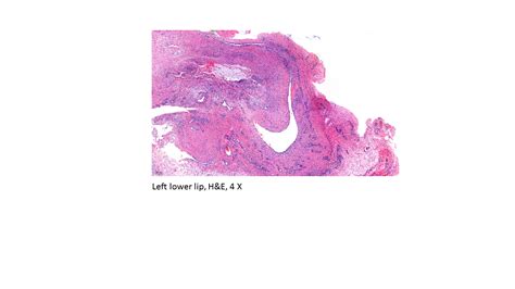 Mucous Retention Cyst Lip Histopathology Pdf Free