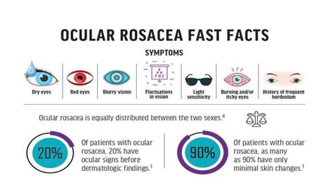 Ocular Rosacea Introduction Symptoms And Causes Diagnosis