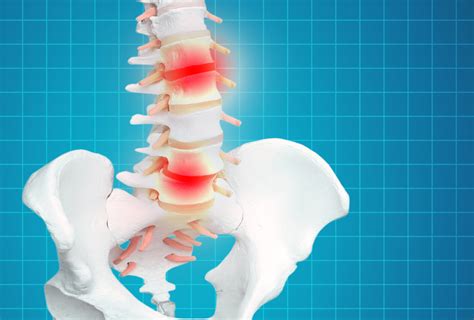 Degenerative Disc Disease Archives Spinal Backrack