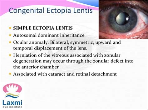 Ectopia Lentis