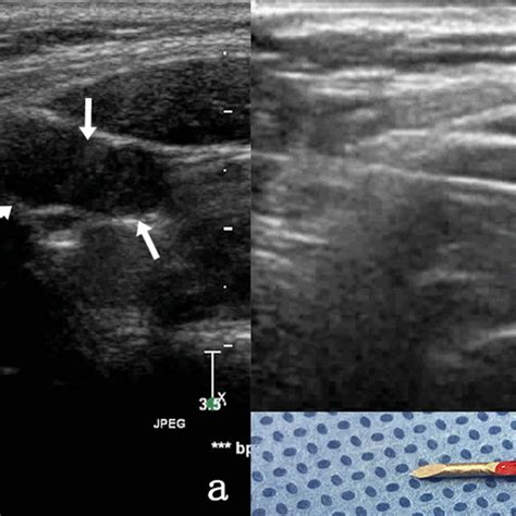 A Lymph Node Enlargement In Ipsilateral Neck Region Ii Was Found In A