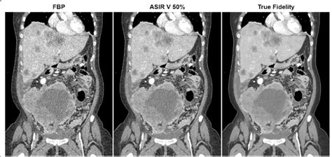 Patient Exam Reconstructed With Fbp Left An Iterative Algorithm Download Scientific Diagram