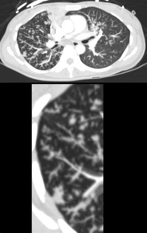 000 Tree In Bud Sign The Common Vein