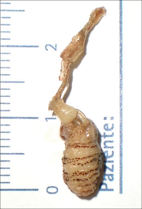 Dermatobia Hominis Small Migrants Hidden In Your Skin Pmc