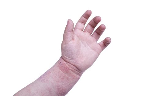 Los mejores consejos para aliviar tu dermatitis atópica Blog del RICOFSE