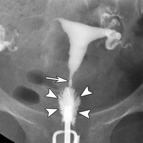 The Fluid In Cervical Canal