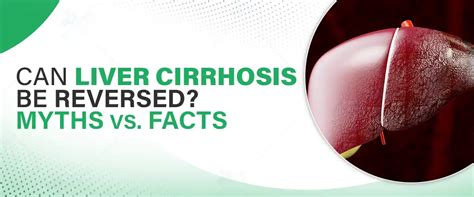 Can Liver Cirrhosis Be Reversed Myths Vs Facts