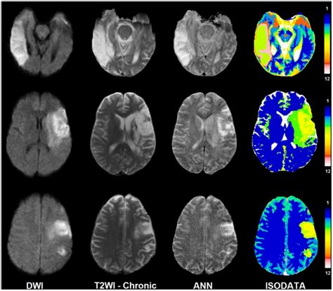 In Isodata Maps The Lesions Are Clustered Into 2 To 3 Different