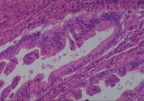 Novus Biologicals Human Colon Tissue Microarray Rectal Cancer Human