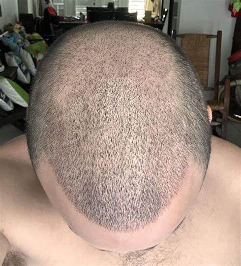 Update Scabs Are Off After 8 9 Days After Surgery R Tressless