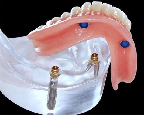 Implante Dentário Só Sorriso Odontologia Recreio do Bandeirantes