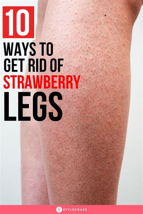 10 Natural Ways To Get Rid Of Strawberry Legs Strawberry Legs Health