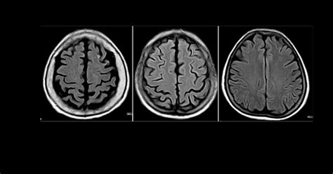 Cortical Atrophy Symptoms Causes And Associated Disorders