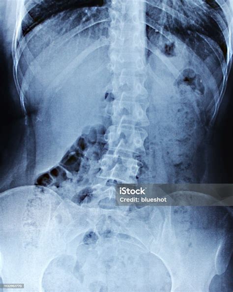 Hasil Rontgen Tulang Belakang Foto Stok Unduh Gambar Sekarang Pemindaian Mri Postur Tubuh