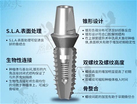 韩国美格真种植体的优缺点及价格已罗列，来瞅和登腾哪个好荔枝美
