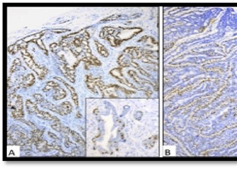 A Gata 3 Ihc 10x Shows Diffuse Nuclear Positivity Inset Shows Download Scientific Diagram