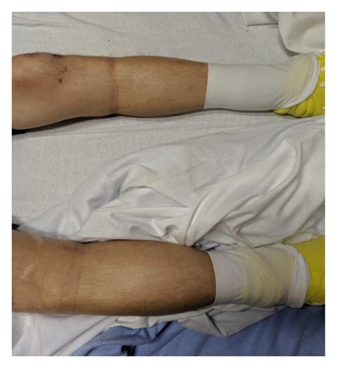 Bilateral Pedal Edema To The Level Of The Knees Secondary To Insulin
