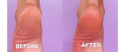Tanpa Aloe Vera Ini Cara Bikin Tumit Kaki Retak Jadi Lembut Bak Kulit